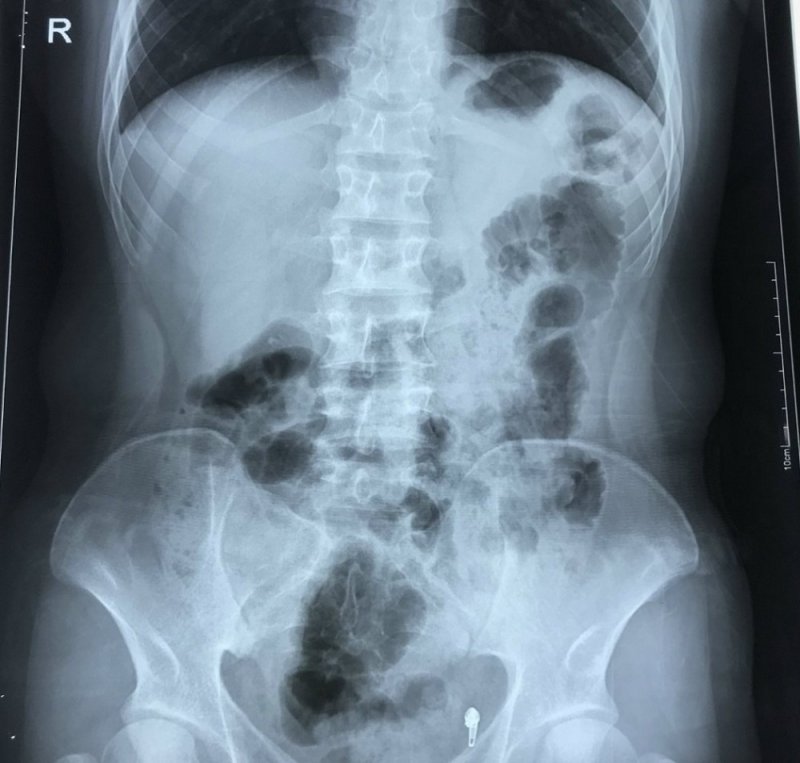 17-year-old boy has rare condition: heart in right side of chest ...